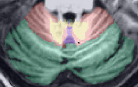 Vermis Definition - IACL