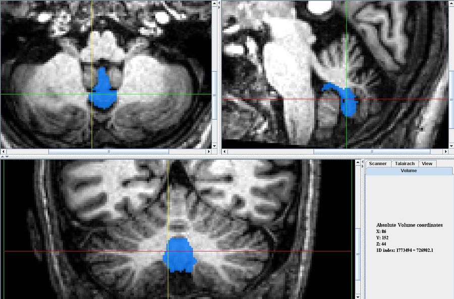 Vermis Definition - IACL