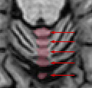 Vermis Definition - IACL