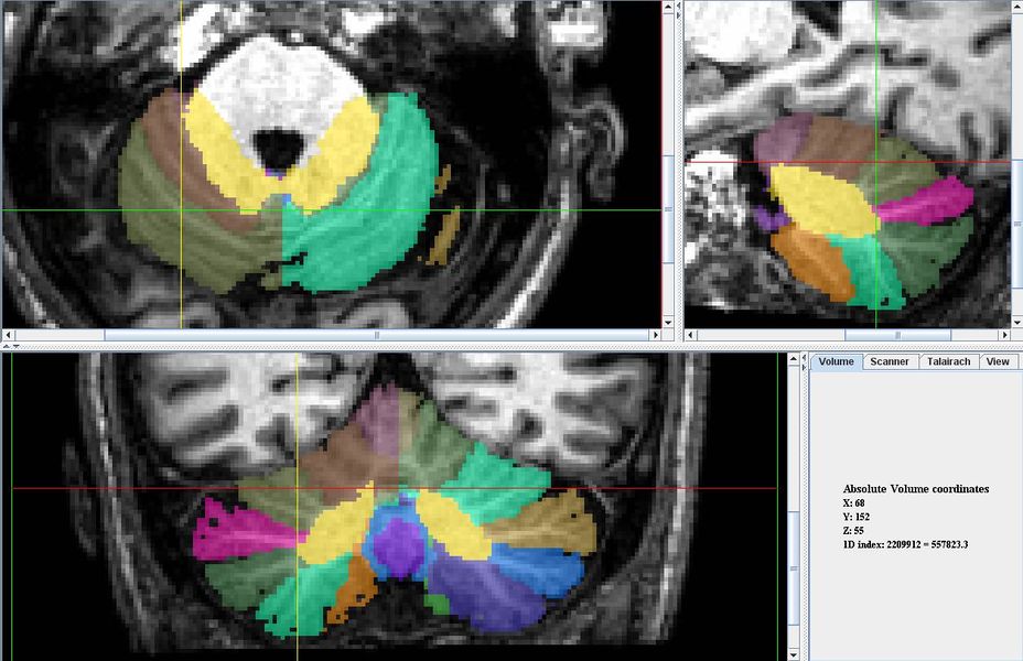Lobule VI - IACL